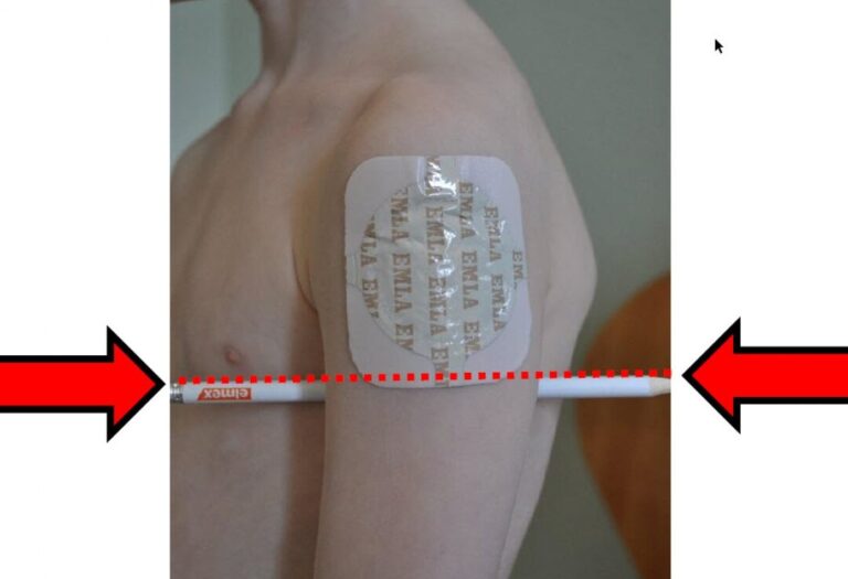 EMLA Pflaster: Anwendung, Vorteile und Tipps zur effektiven Nutzung