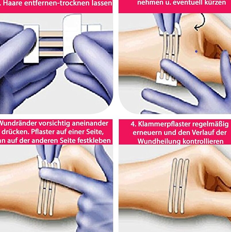 Klammerpflaster richtig anwenden: Eine Schritt-für-Schritt Anleitung