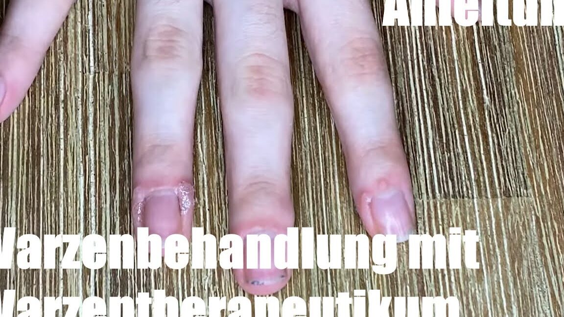 Verrumal Lösung Anwendung: Tipps und Tricks für eine effektive Behandlung